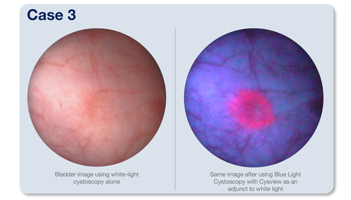 Blue Light Cystoscopy Locations | Shelly Lighting